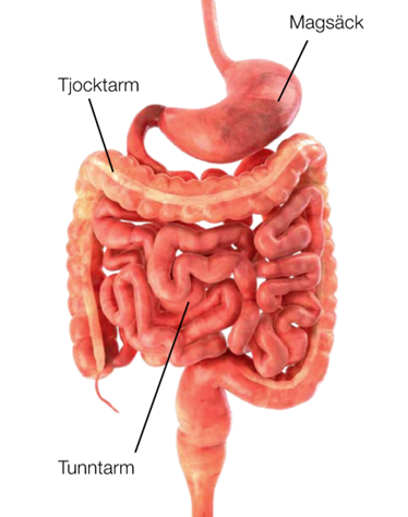 Korttarmsyndrom - Short Bowel Syndrome | Gastrokoll